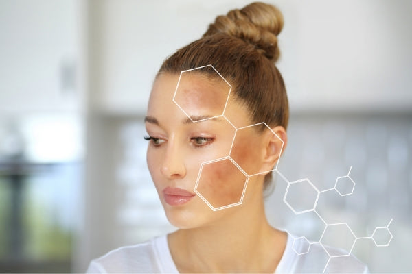 THE IMPACT OF LED LIGHT THERAPY ON THE SKIN'S IMMUNE RESPONSE IN ACNE ...